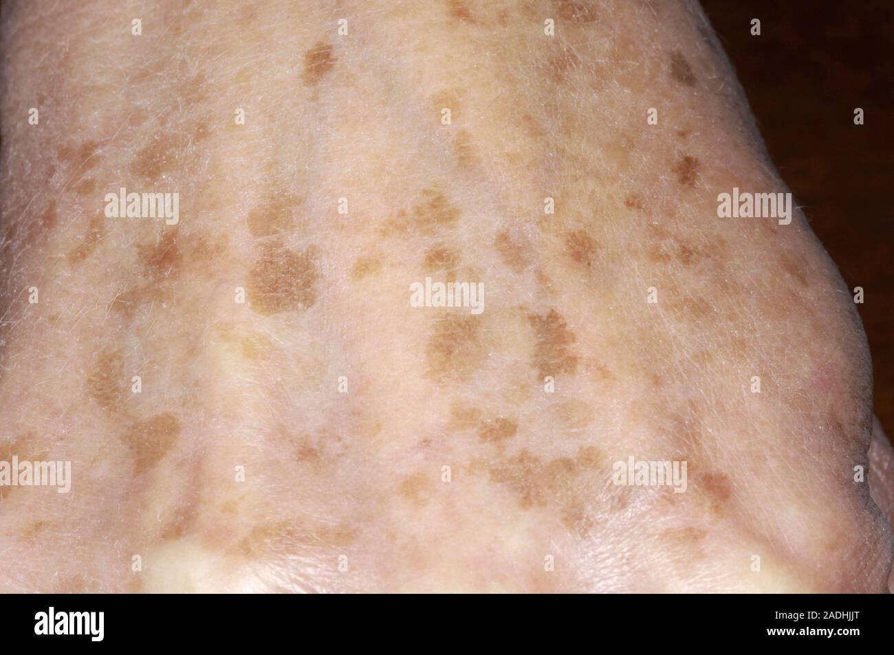 MODEL RELEASED. Liver spots. Close-up of the skin of a 61-year-old ...
