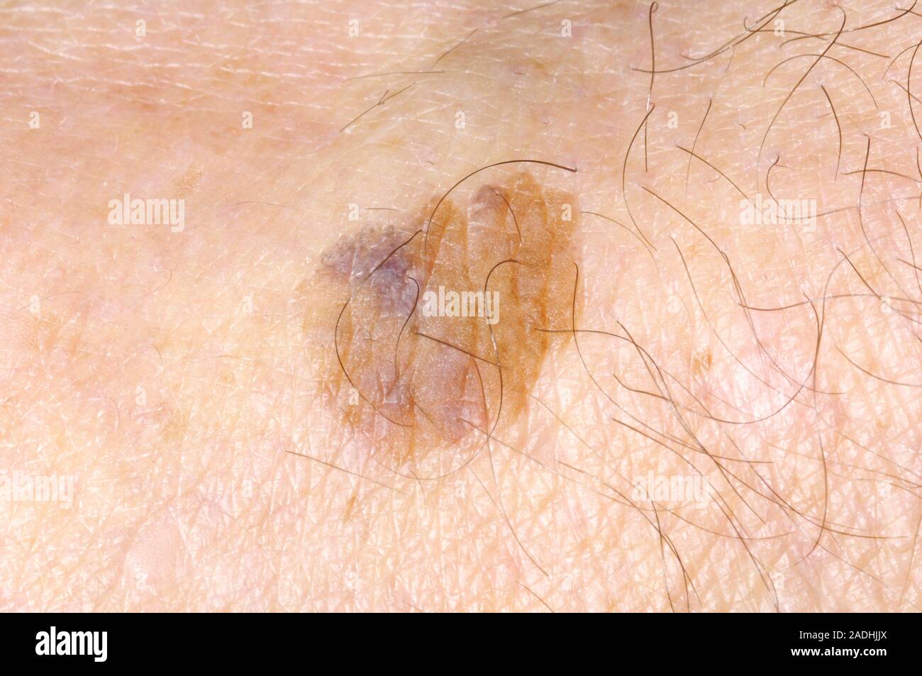 MODEL RELEASED. Lichenoid keratosis. Close-up of the back of the hand ...