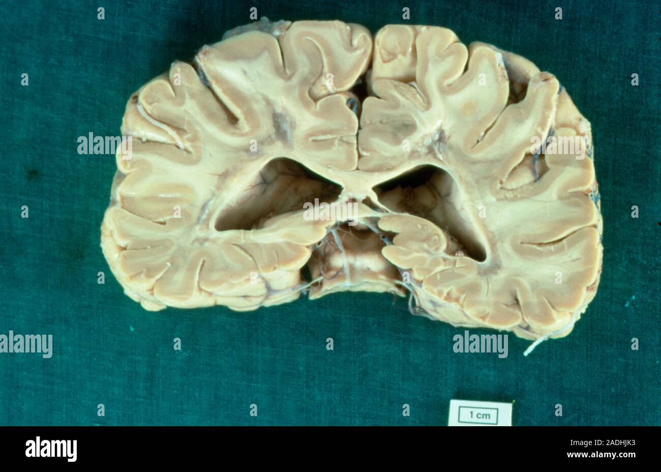 Ordinary photograph of a section of a whole brain affected by multiple ...
