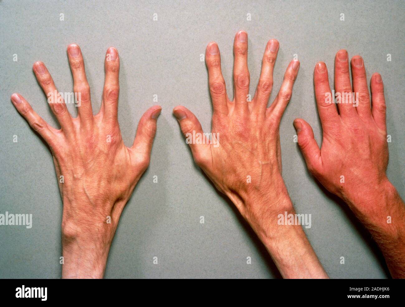 Photograph of the hands of a person suffering from Marfan's syndrome ...