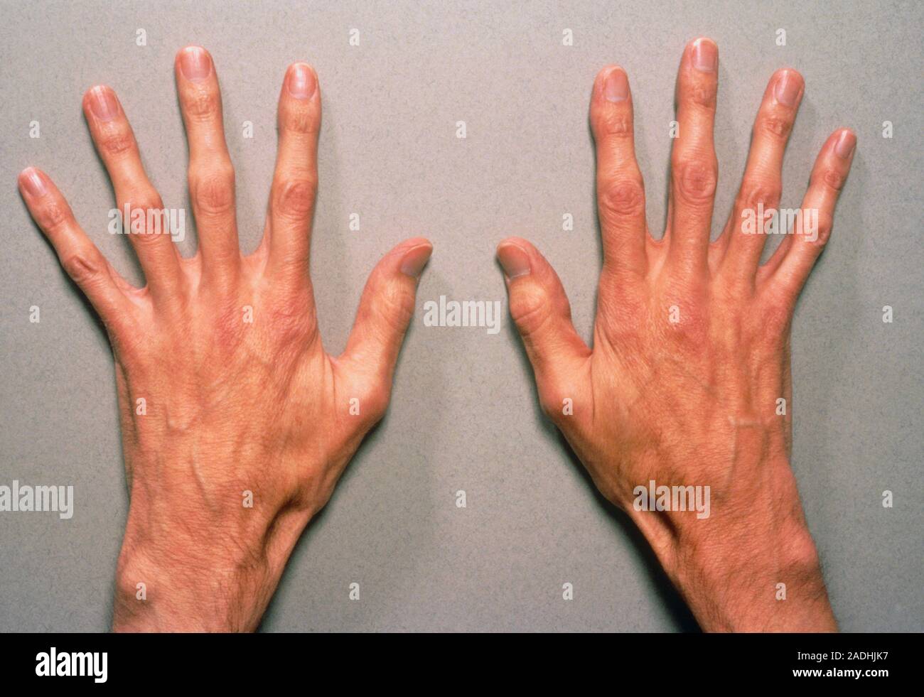 Photograph of the hands of a person suffering from Marfan's syndrome ...