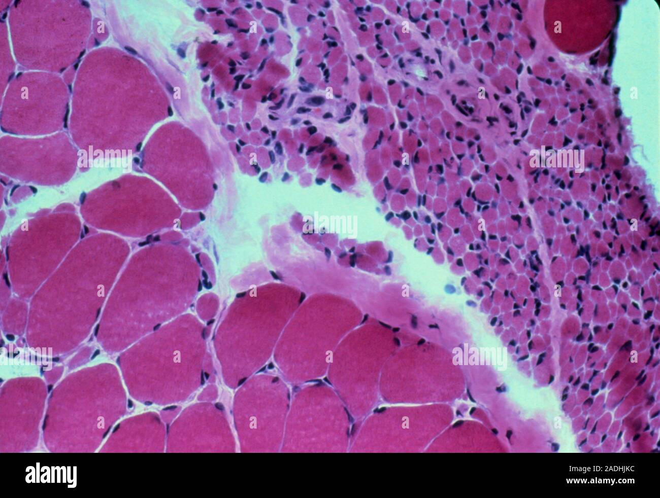 Light micrograph of human muscle showing neurogenic muscular atrophy ...