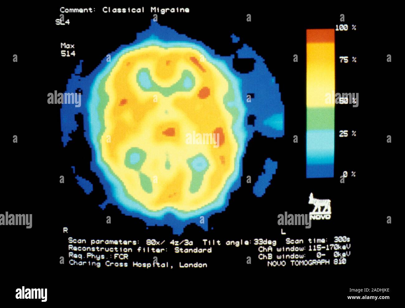 Migraine. Single Photon Emission Tomography (SPET) image of the brain ...