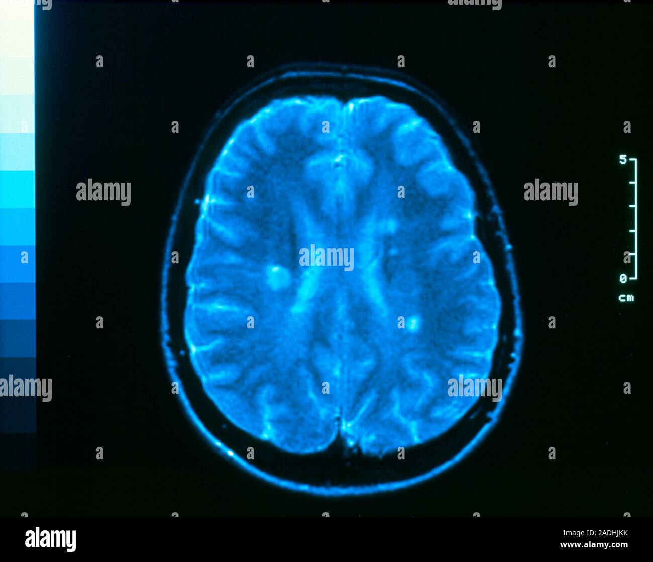 Multiple sclerosis (MS): magnetic resonance image (MRI) of the brain of ...
