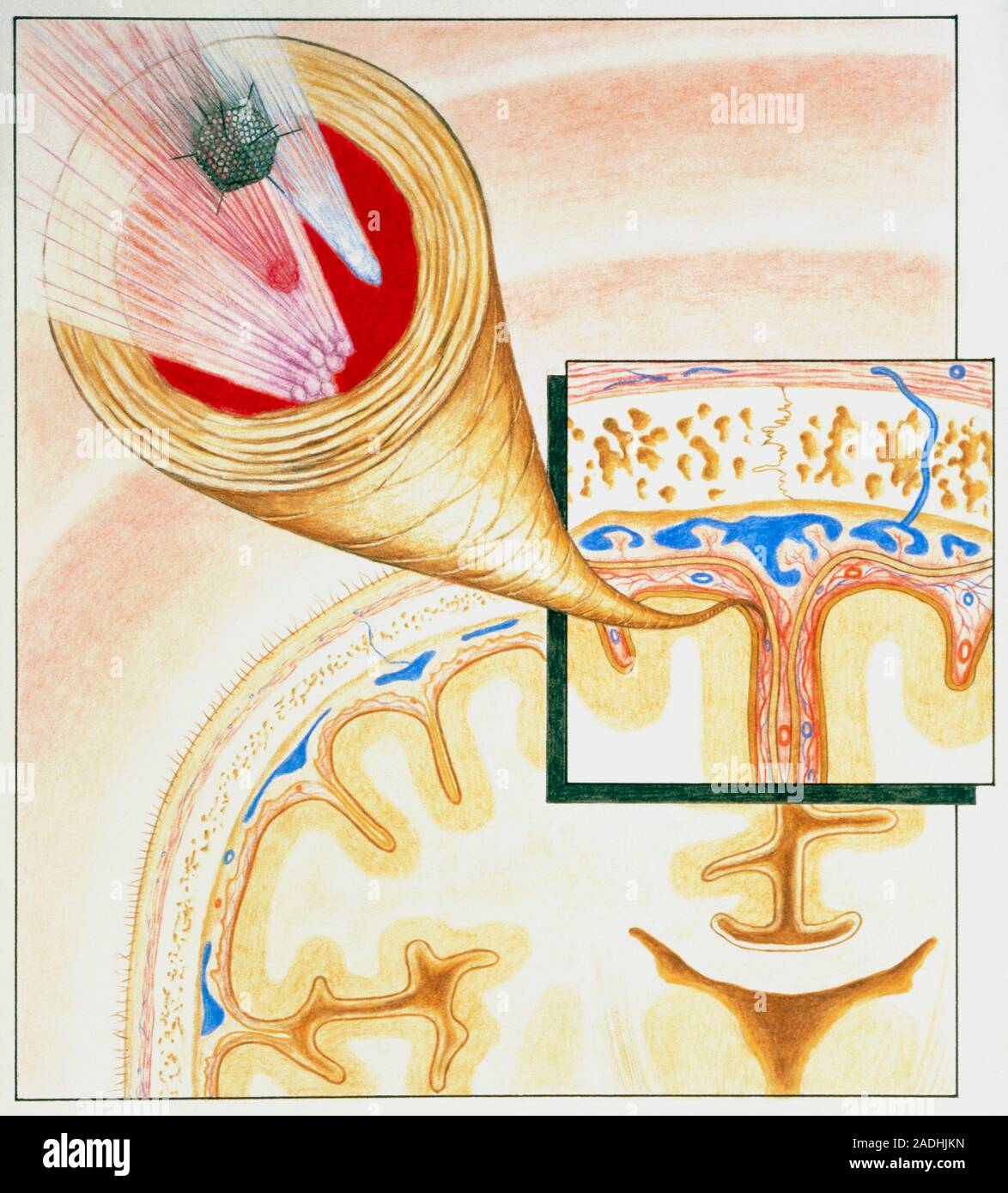 Artwork representing the onset of meningitis. Meningitis is an ...