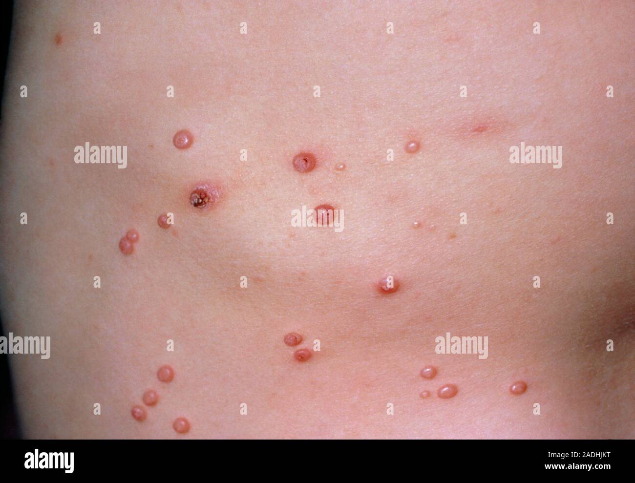Wart-like skin lesions in Molluscum contagiosum, a pox virus infection most commonly seen in ...