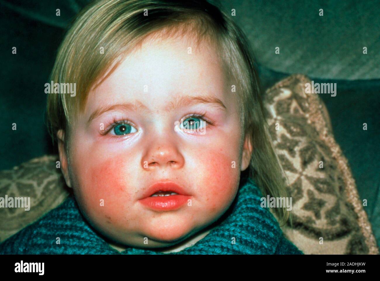 Mumps. Young child affected by mumps (infectious parotitis). This is an ...