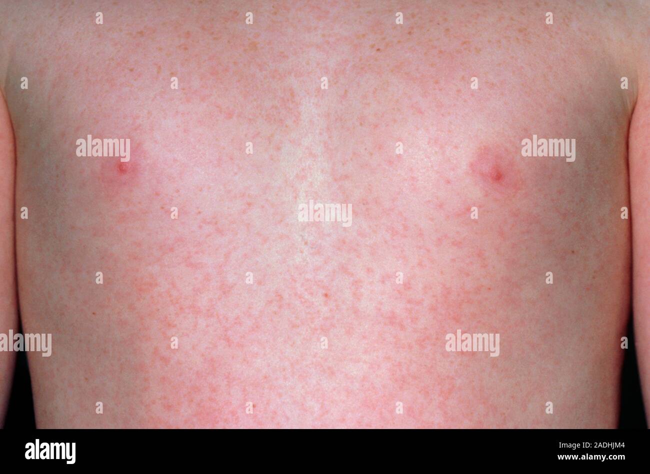 German measles. View of a chest rash in a child suffering from German ...