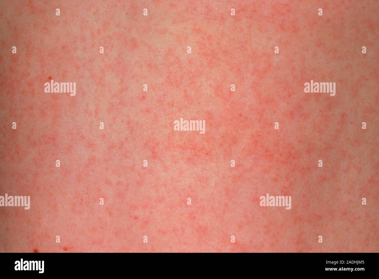 German measles. View of a skin rash in a child suffering from German ...