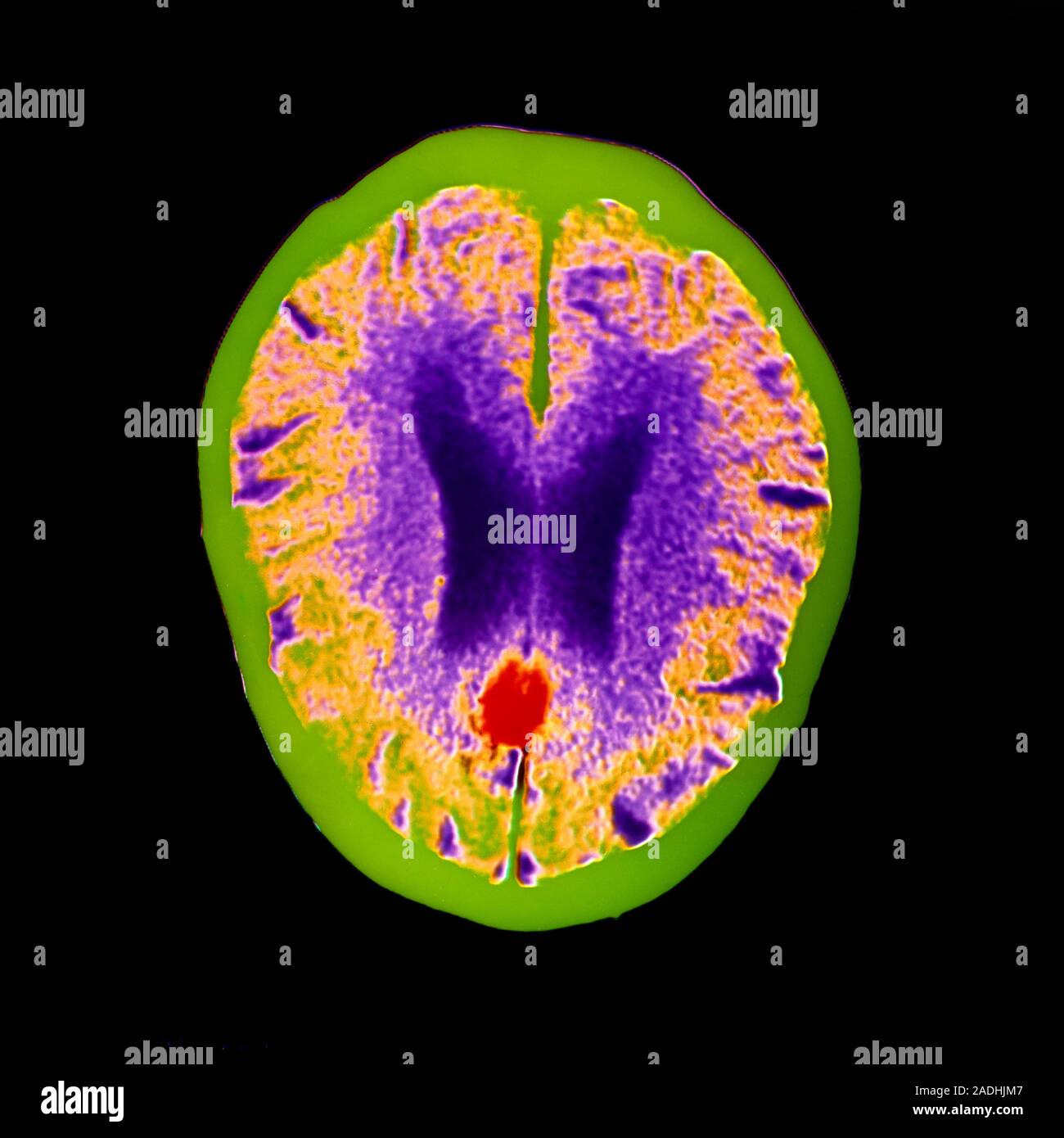 Meningioma. Coloured computed tomography (CT) scan of the brain showing ... Meningioma. Coloured computed tomography (CT) scan of the brain showing ...