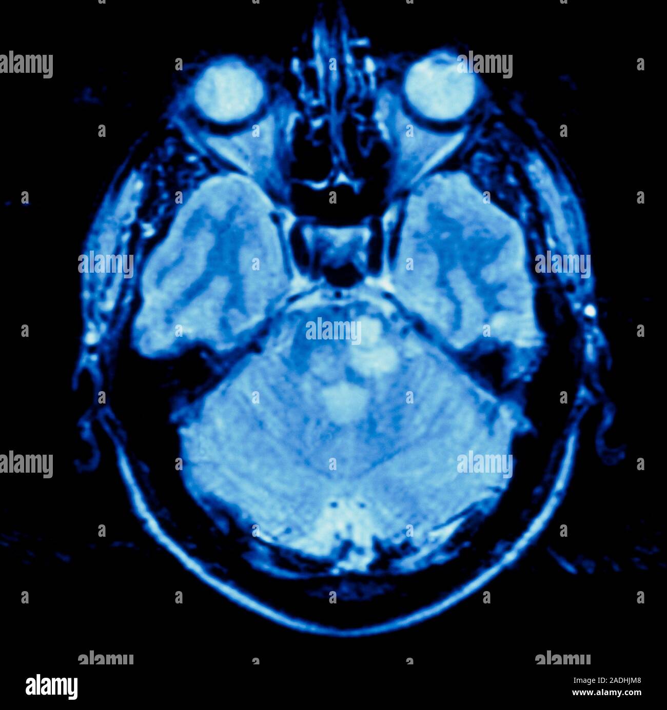 Multiple sclerosis. Magnetic resonance image (MRI) scan of an axial section through the brain of ...