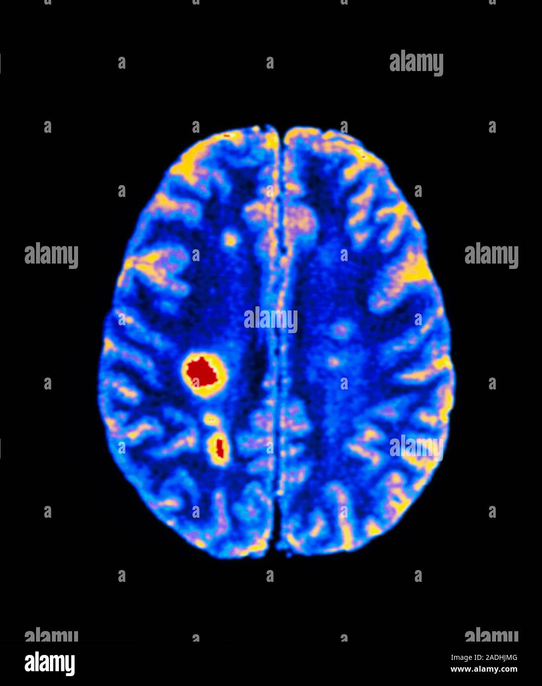 Multiple sclerosis. Coloured magnetic resonance image (MRI) scan of an ...