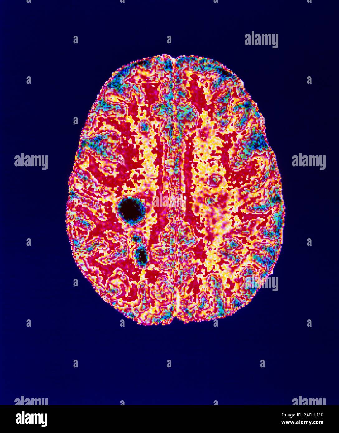 Multiple sclerosis. Coloured magnetic resonance image (MRI) scan of an axial section through the ...