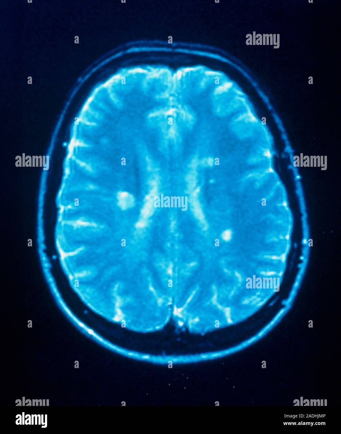 Multiple sclerosis (MS): magnetic resonance image (MRI) of the brain of ...