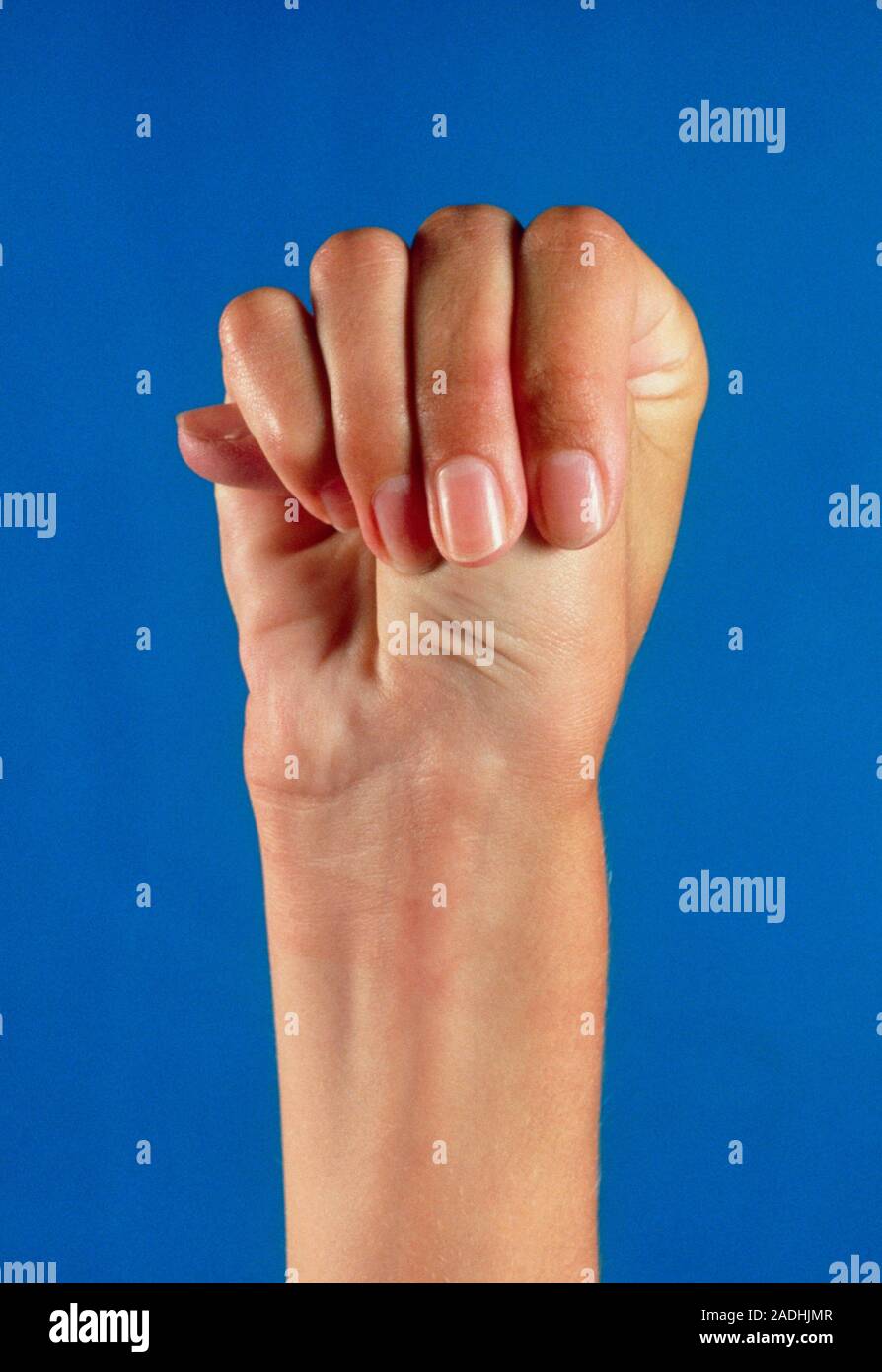 Marfan's syndrome. A double-jointed thumb in the hand of a patient with ...