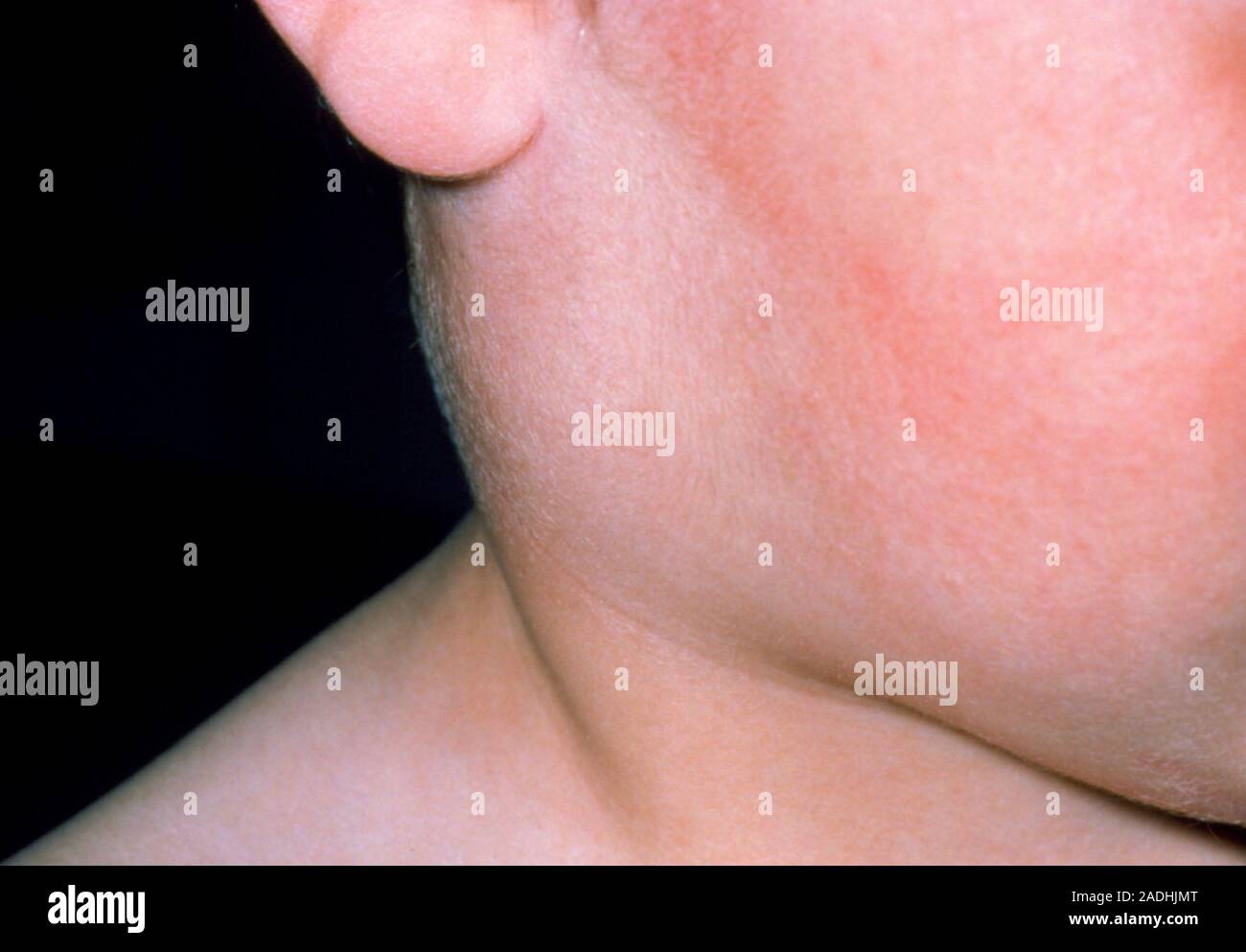 Mumps. Close-up of an inflamed parotid gland in a young child with ...