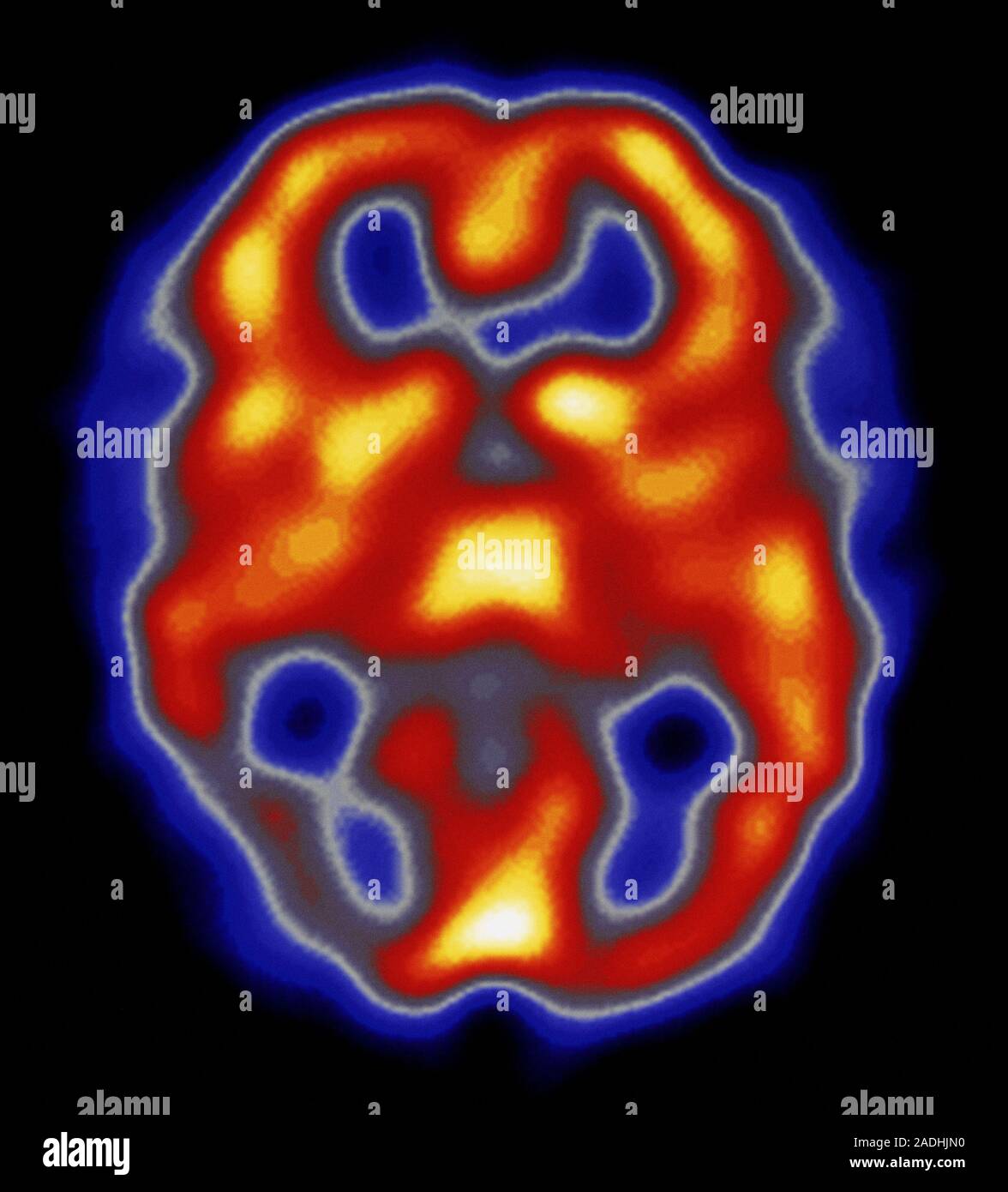 Migraine. Coloured Single Photon Emission Computed Tomography (SPECT ...