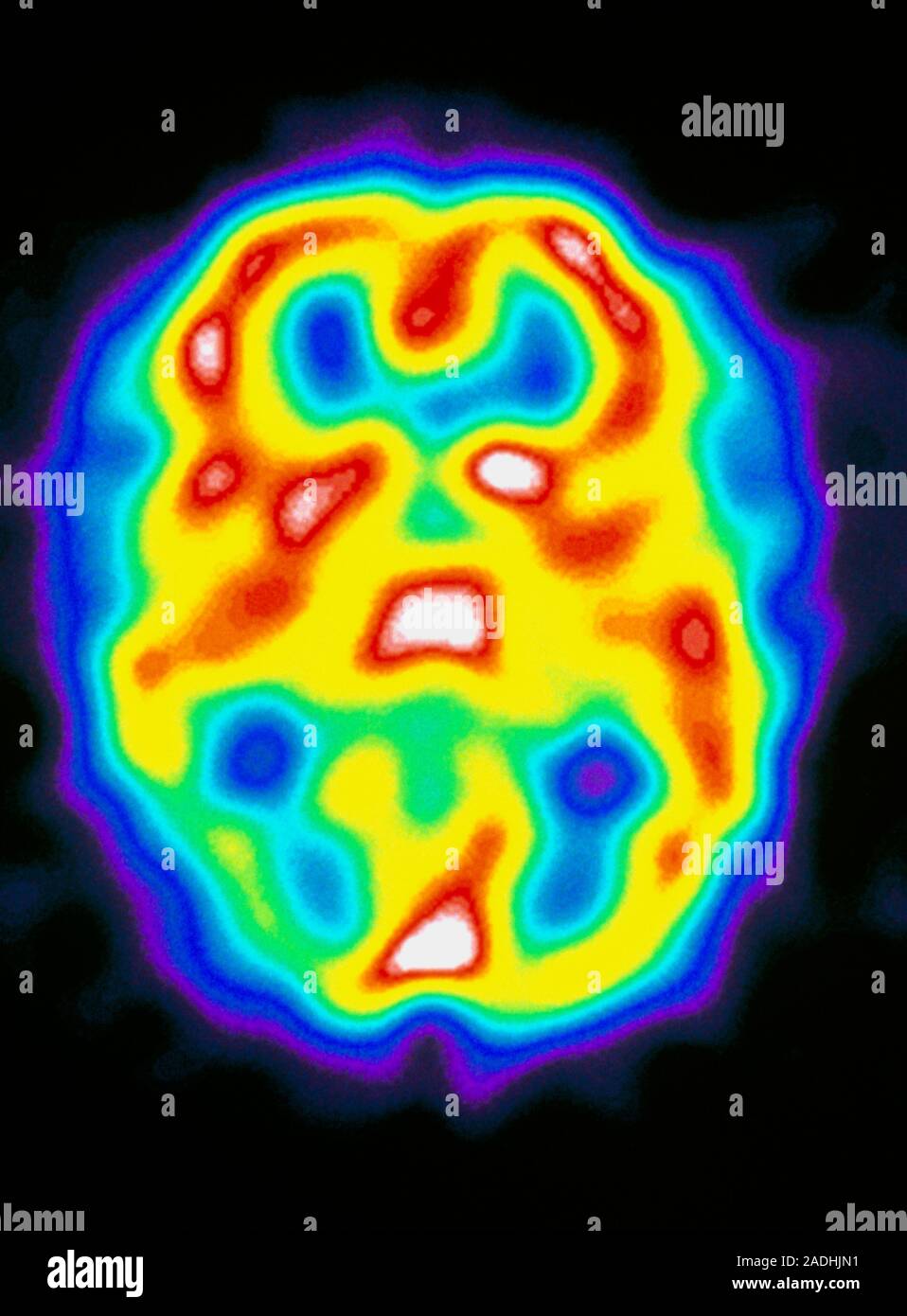 Migraine. Coloured Single Photon Emission Computed Tomography (SPECT ...