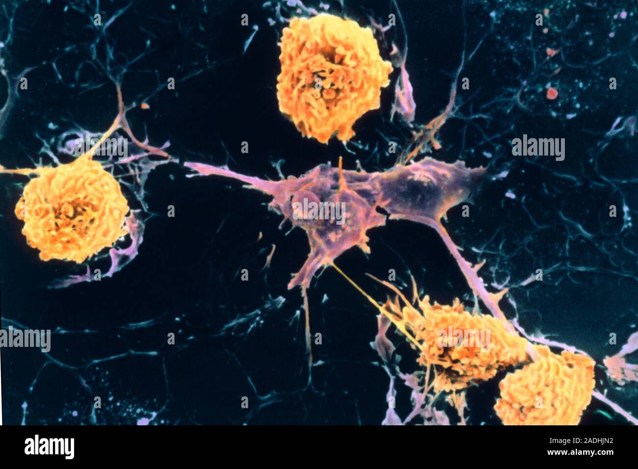 Multiple sclerosis. Coloured Scanning Electron Micrograph (SEM) of ...