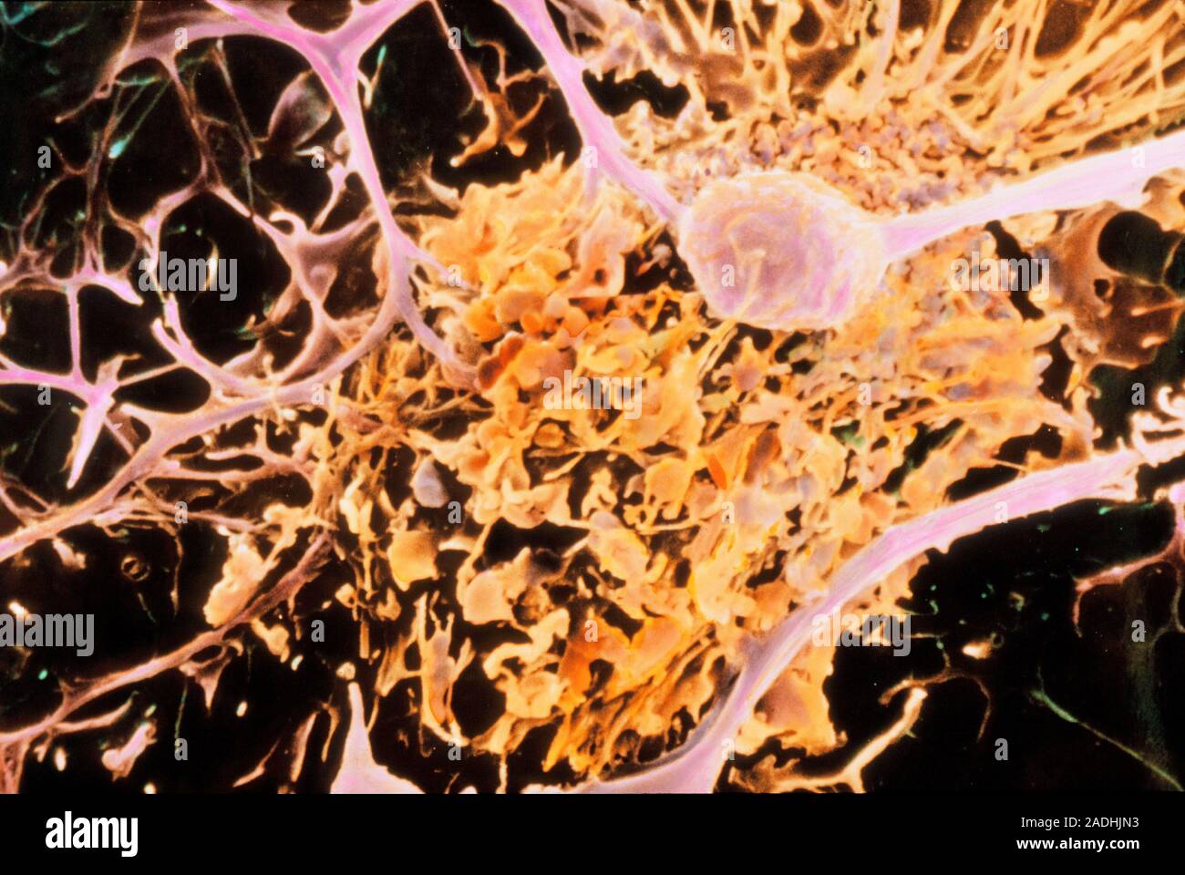 Multiple sclerosis. Coloured scanning electron micrograph (SEM) of a ...
