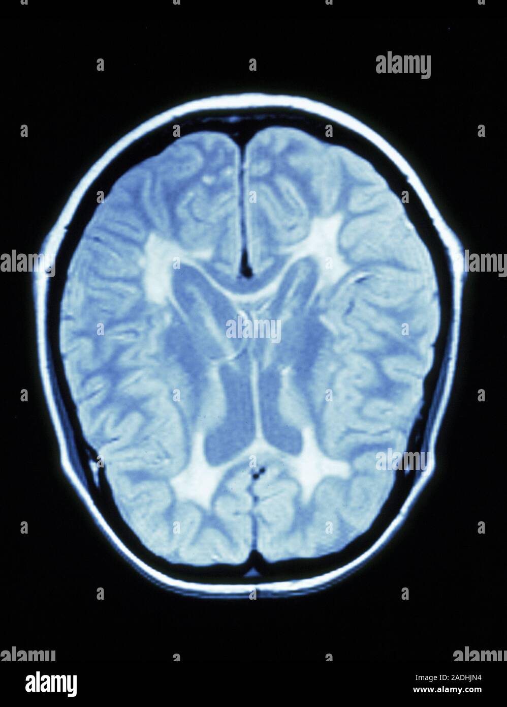 Multiple sclerosis. Magnetic Resonance Imaging (MRI) scan of an axial section through the brain ...