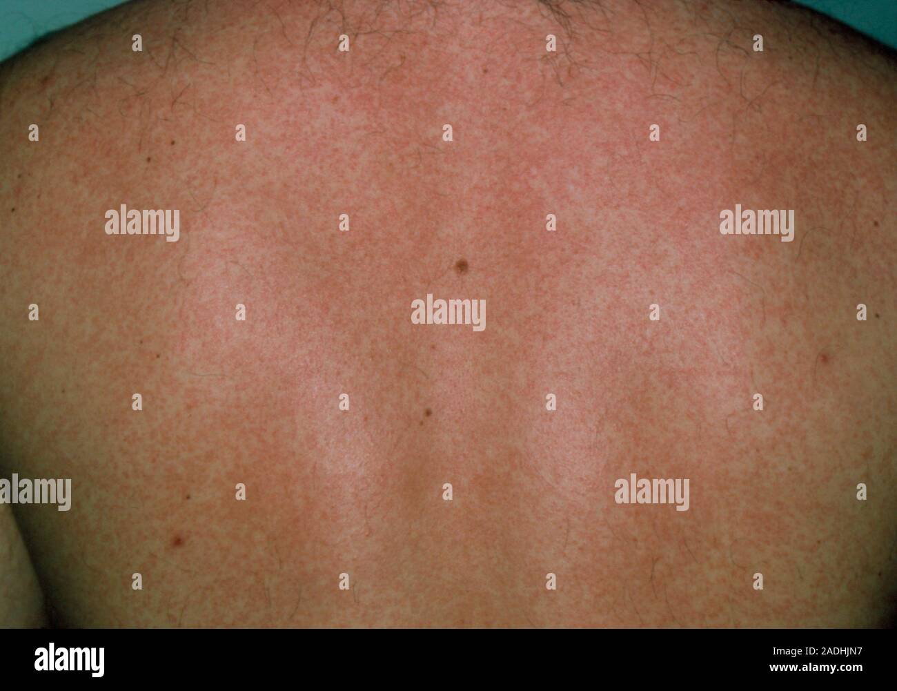 Rubella. A rash of red spots on a man's back caused by rubella (German ...