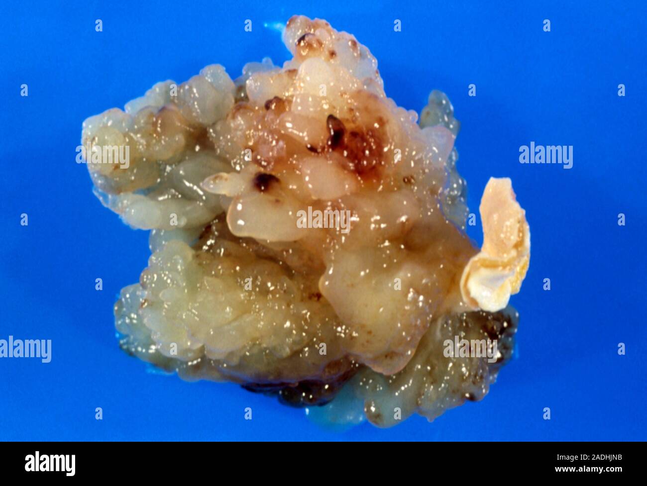 Atrial myxoma. Gross specimen of an atrial myxoma, a benign, jelly-like ...