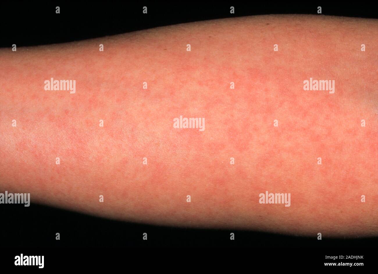 German measles. Arm of a 29-year-old woman showing rash due to German ...