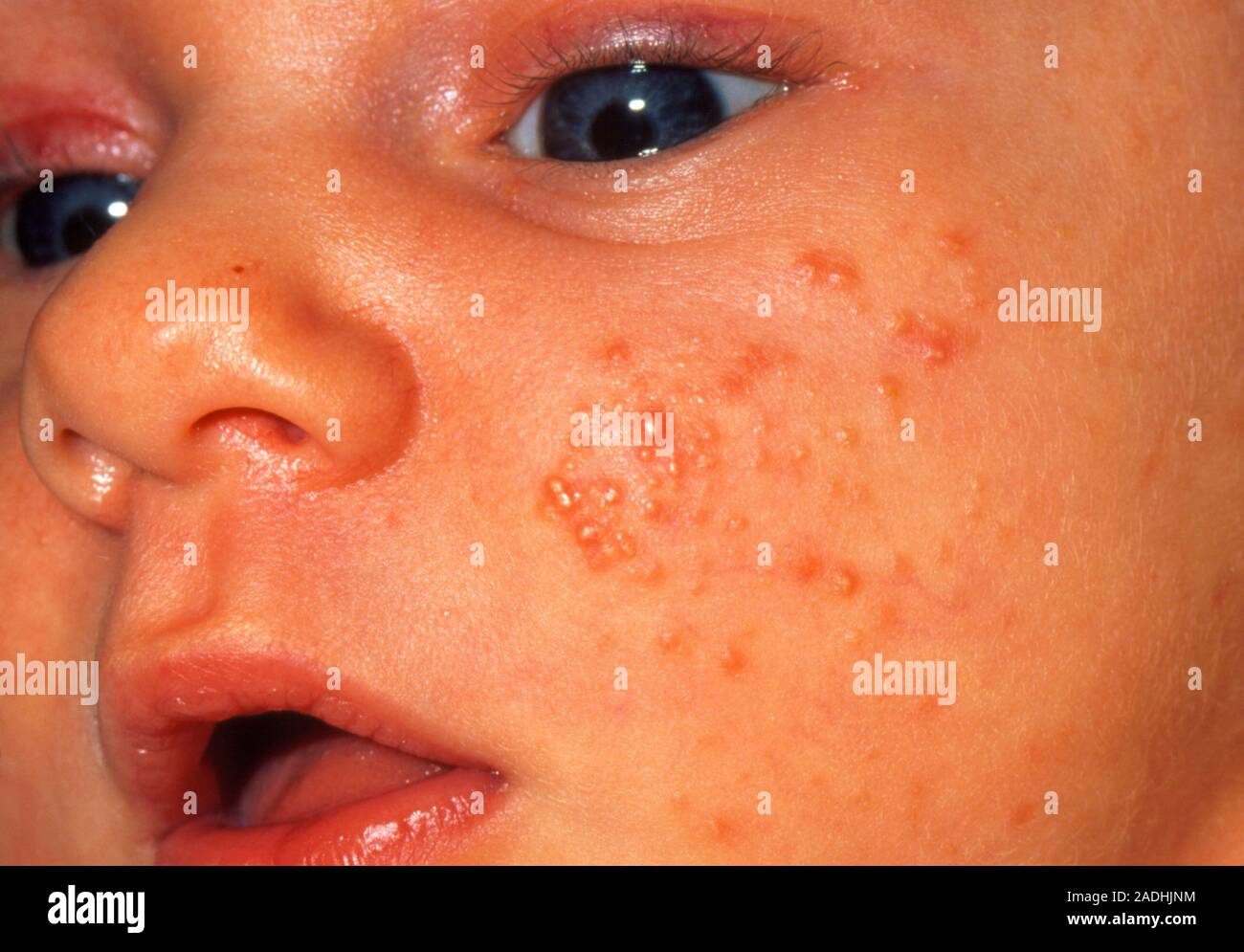 Milia on the cheek of a one-month-old baby boy. Milia are small, hard ...