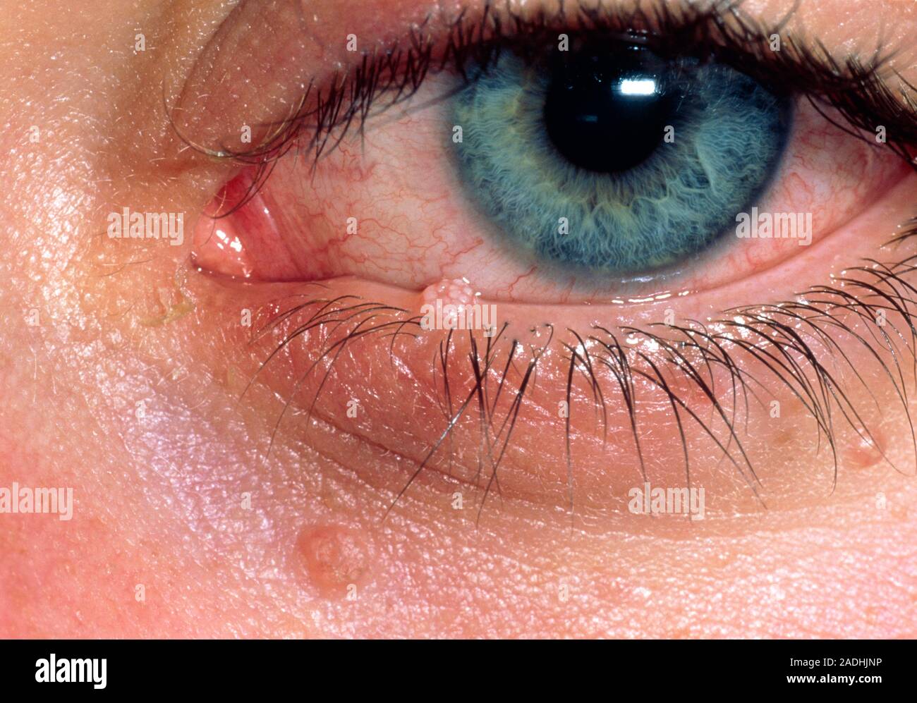Molluscum contagiosum. Lump caused by Molluscum contagiosum virus on ...