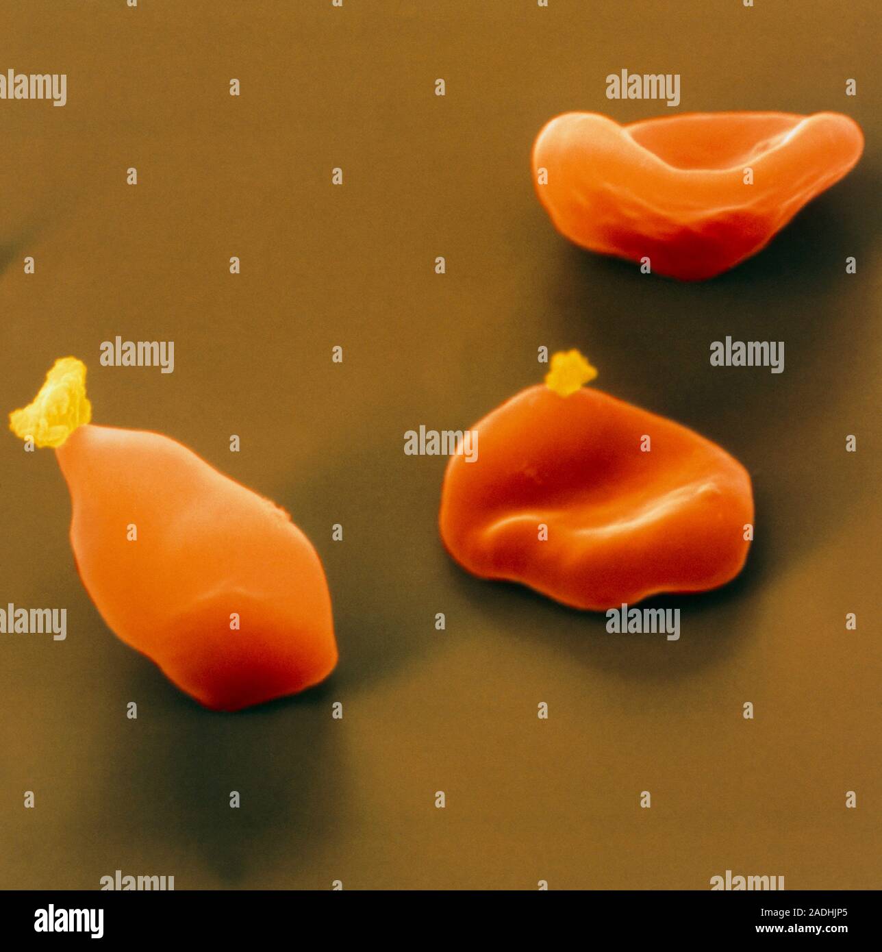 Malaria. Coloured scanning electron micrograph (SEM) of red blood cells ...
