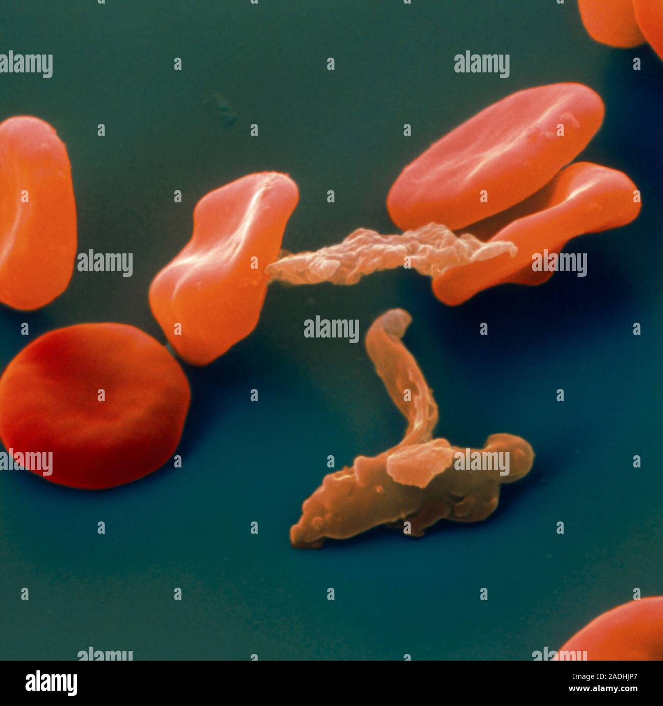Malaria. Coloured scanning electron micrograph (SEM) of red blood cells ...