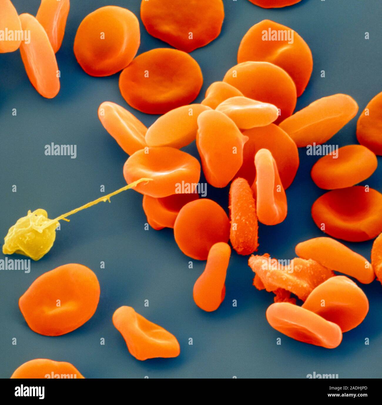 Malaria. Coloured scanning electron micrograph (SEM) of the gametocyte ...