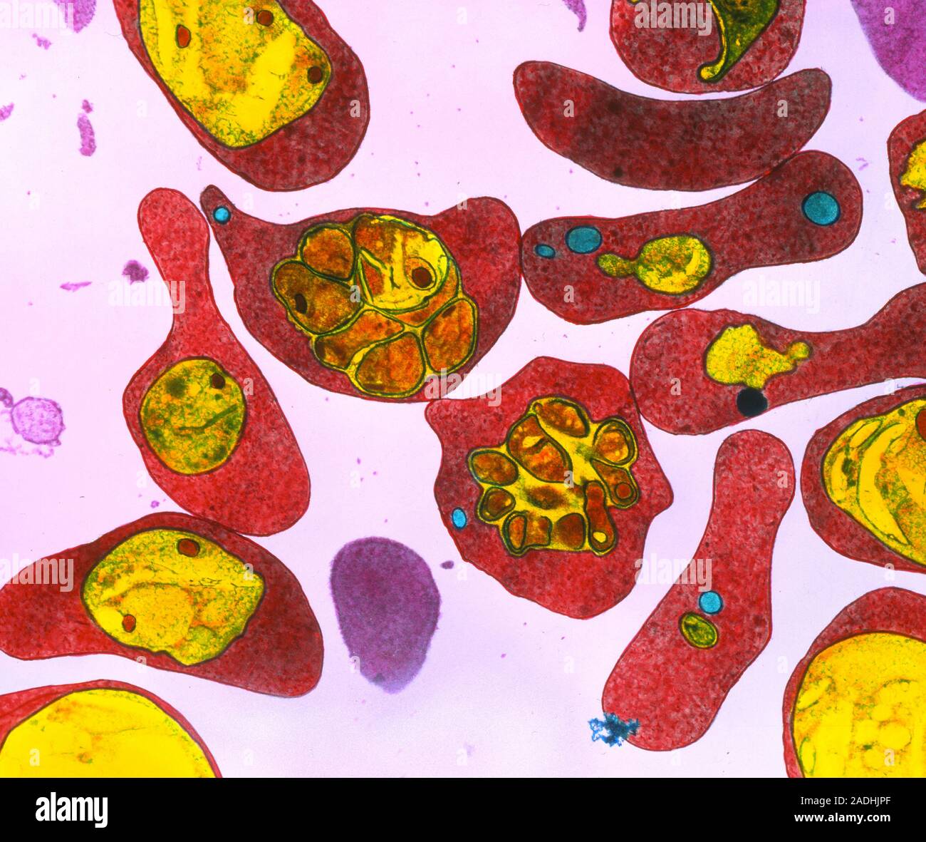 Malaria infected blood. Coloured transmission electron micrograph of a ...