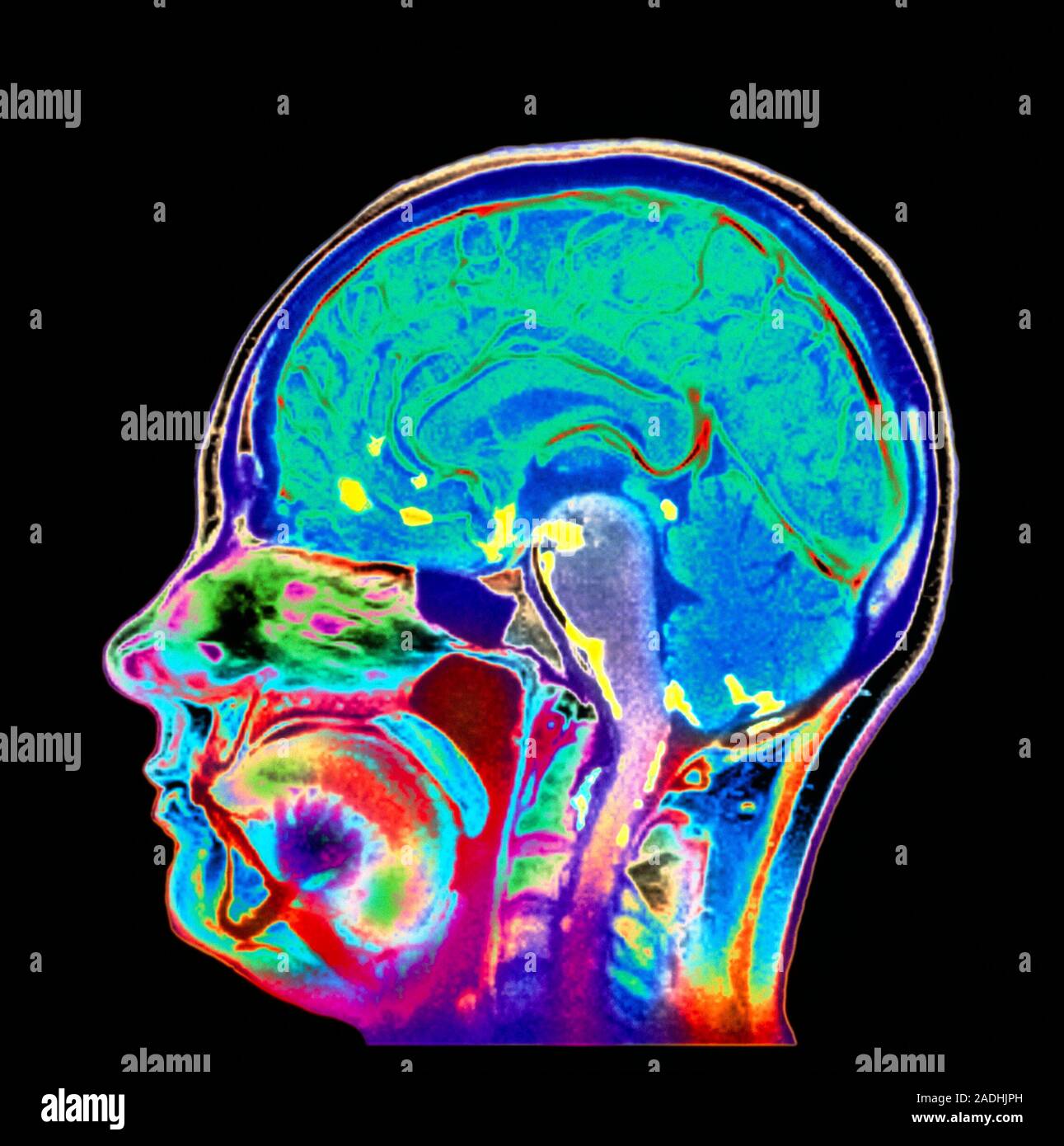 Meningitis. Coloured magnetic resonance imaging (MRI) scan of a section ...