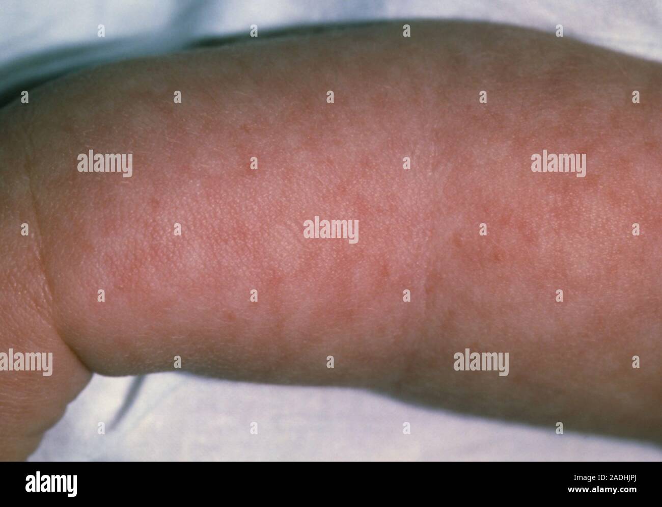 Meningitis rash. Close-up of the arm of a 6 week old baby girl showing ...