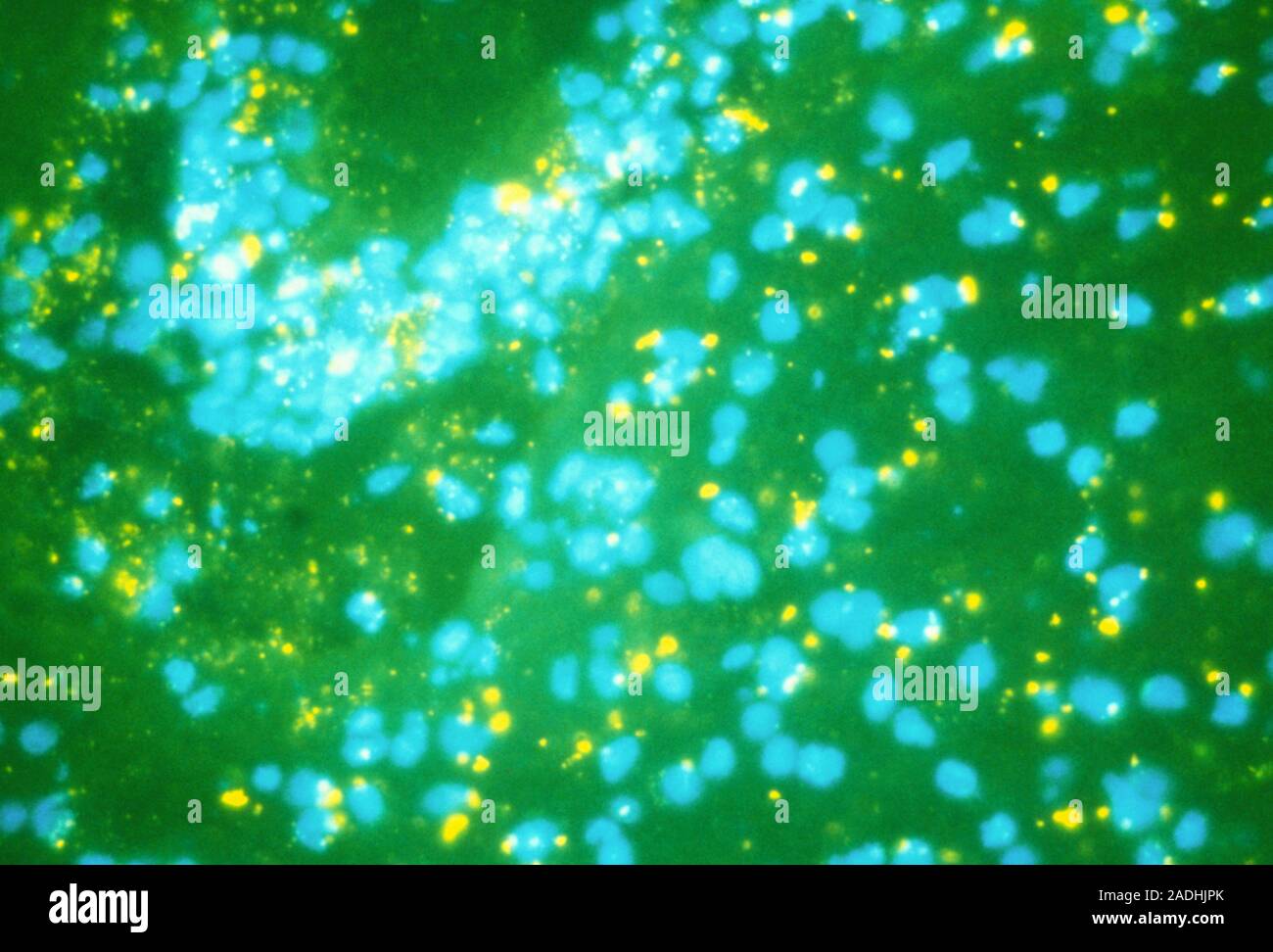 Multiple sclerosis. Fluorescence light micrograph of a section through ...