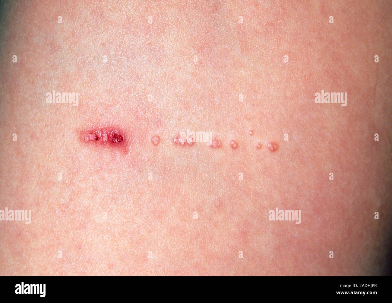 Molluscum contagiosum. View of a line of lesions on the skin of a 10 ...