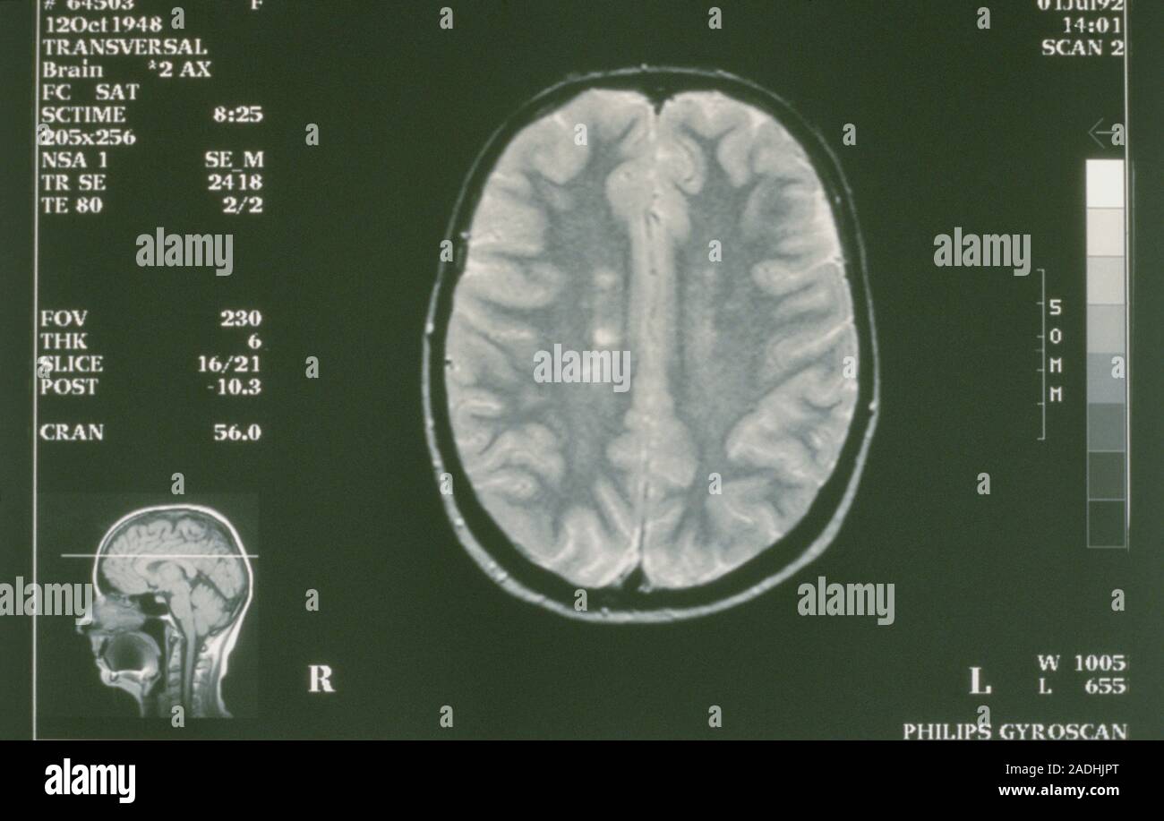 Multiple sclerosis. Magnetic resonance imaging (MRI) scan of the brain ...