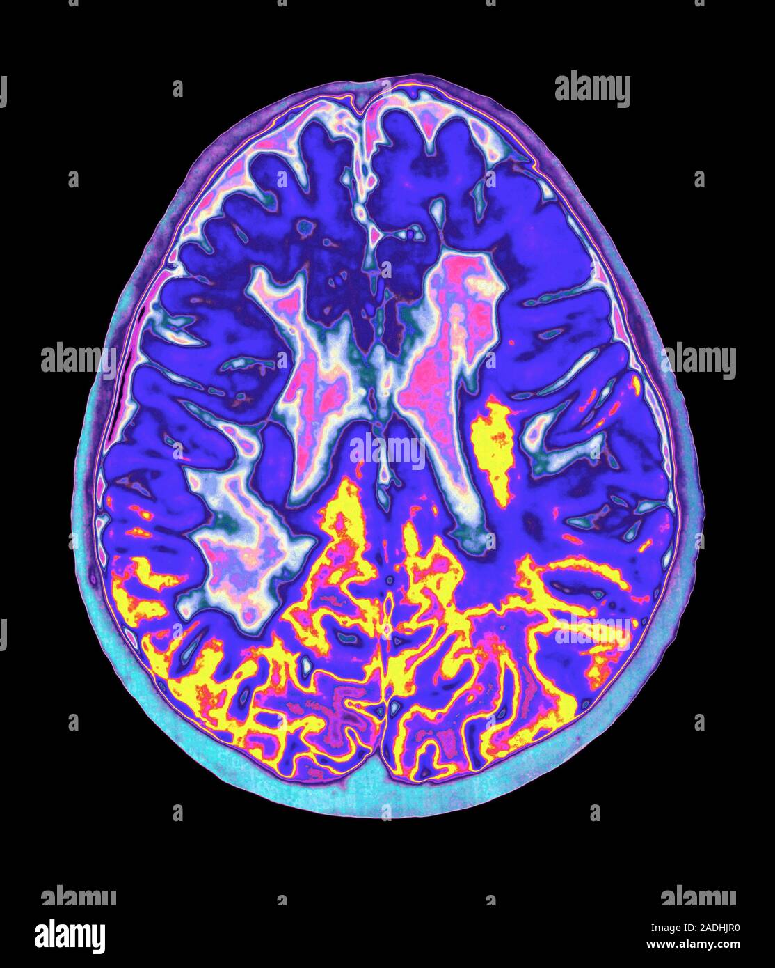 Multiple sclerosis. Coloured magnetic resonance imaging (MRI) scan of ...