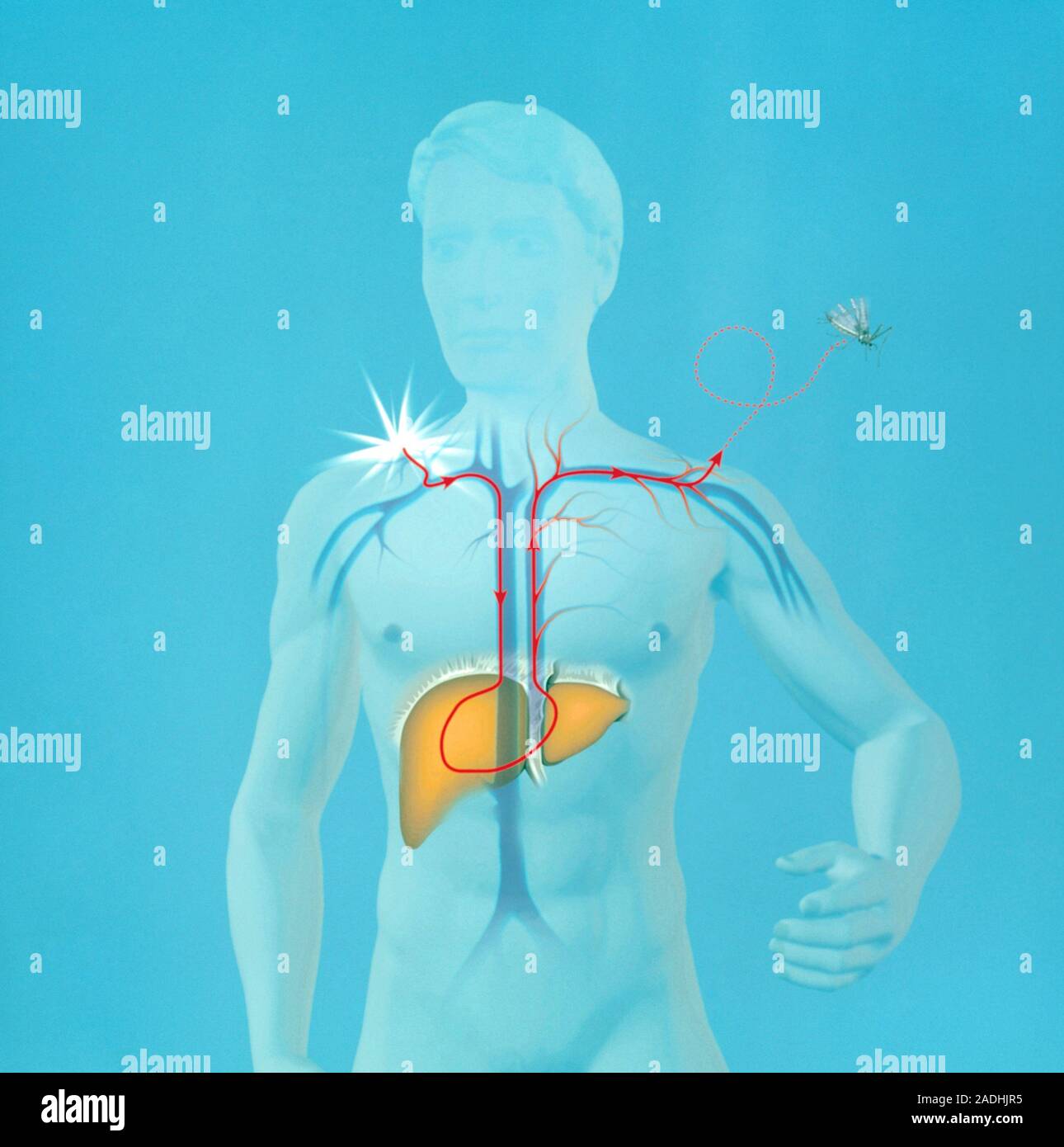 Malaria in body. Computer illustration of the passage of malaria ...