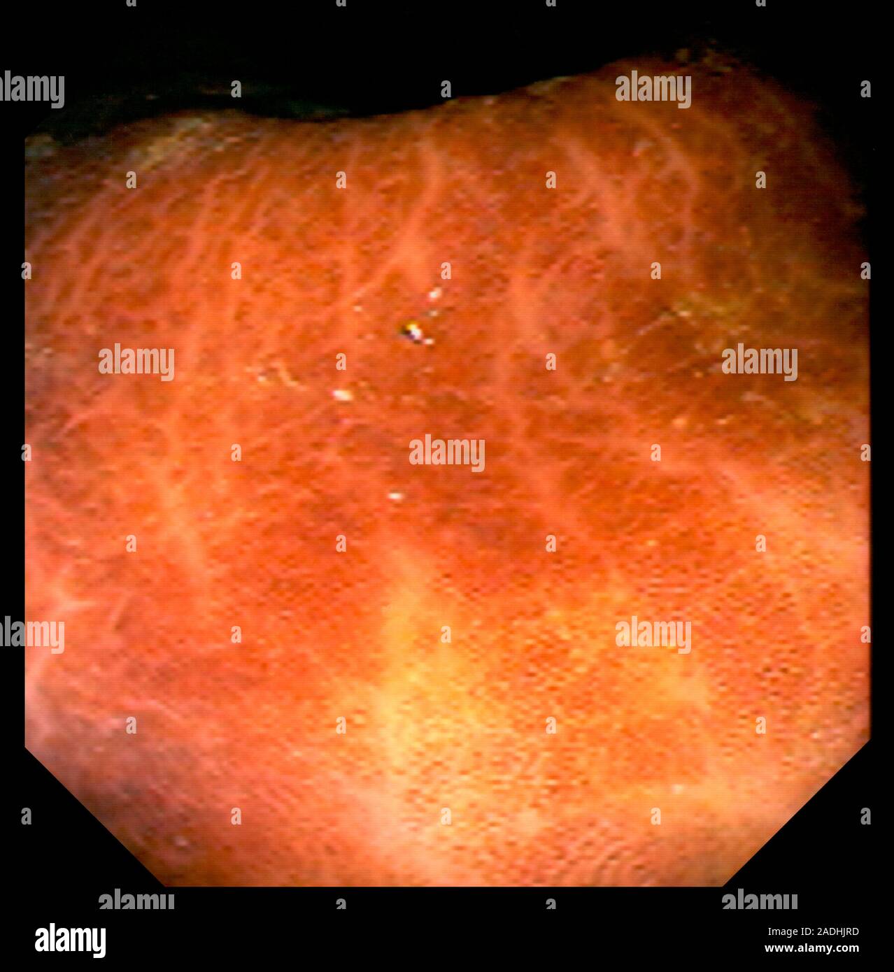 Stained colon. Endoscope view of a dark patch (upper right) in the ...
