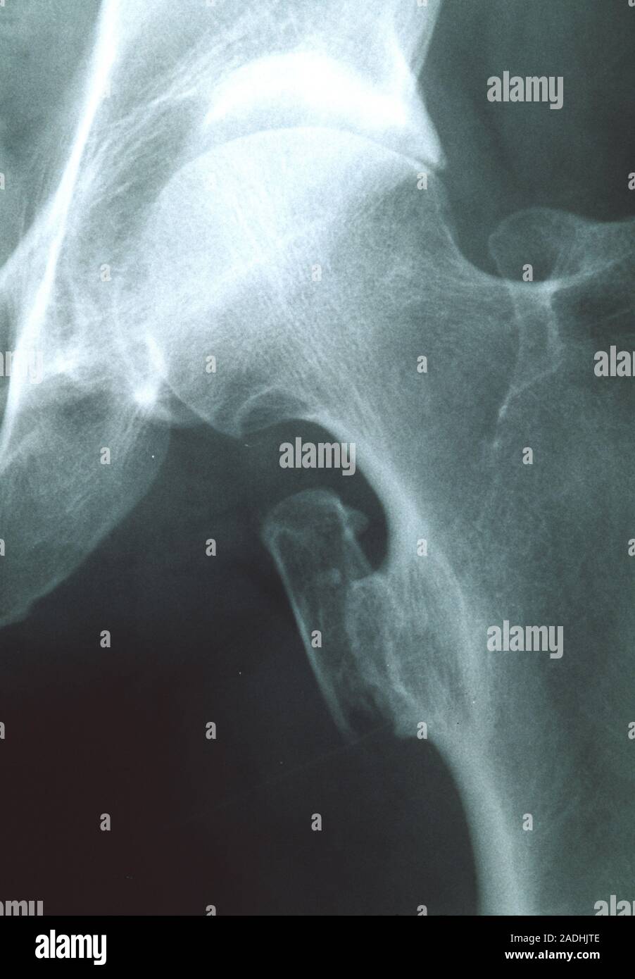 Abnormal bone growth. X-ray of the hip joint of a 60-year-old man ...