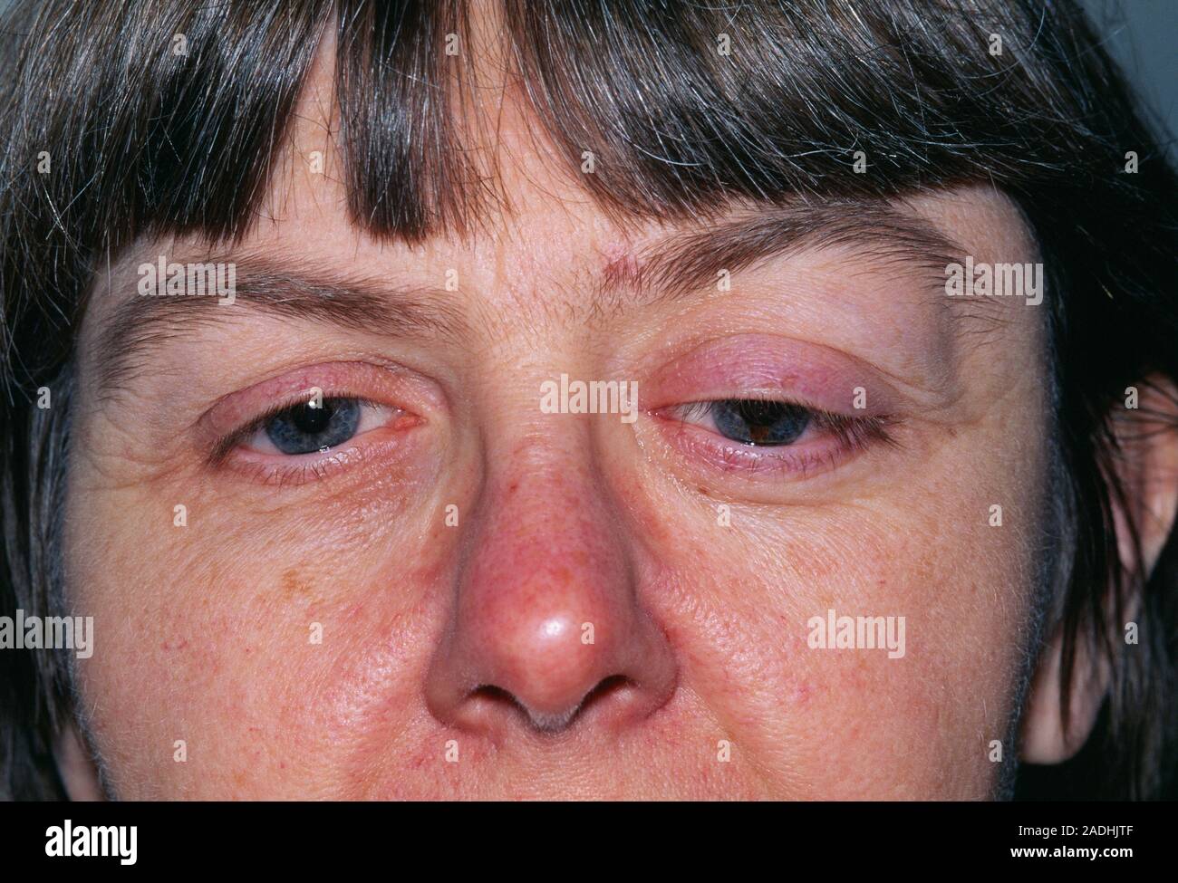 Meningioma eye bulge. Face of a 50-year-old woman with a bulging eye ...