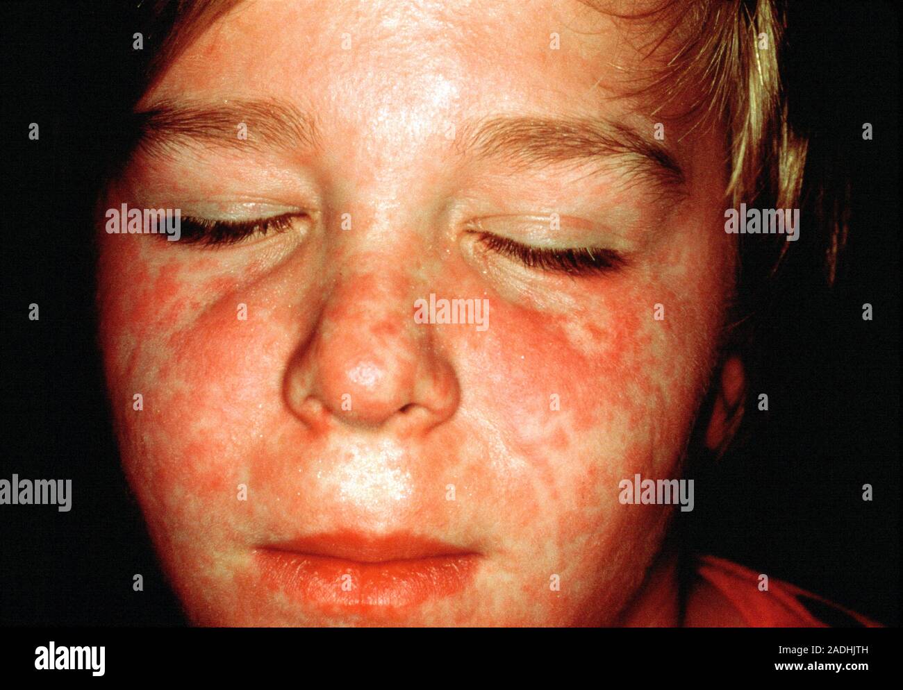 Measles rash on a child's face. Measles is a highly infectious viral ...