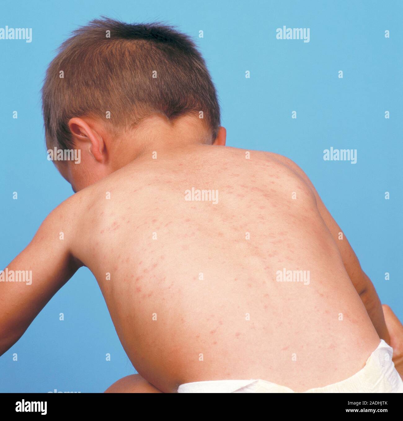 Measles rash on a child's back. Measles is a highly infectious viral ...