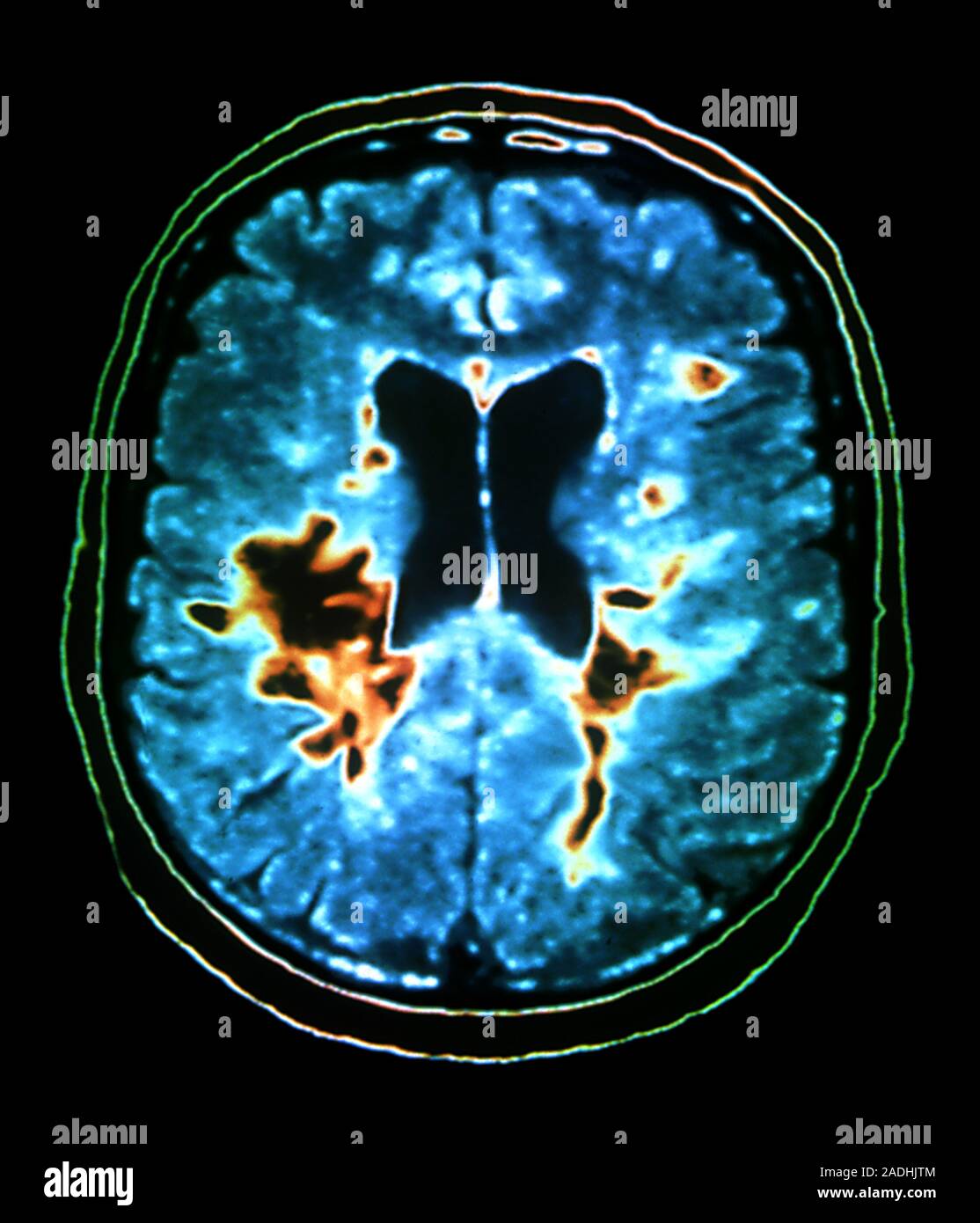 Multiple sclerosis. Coloured magnetic resonance imaging (MRI) scan of the brain of a patient who ...