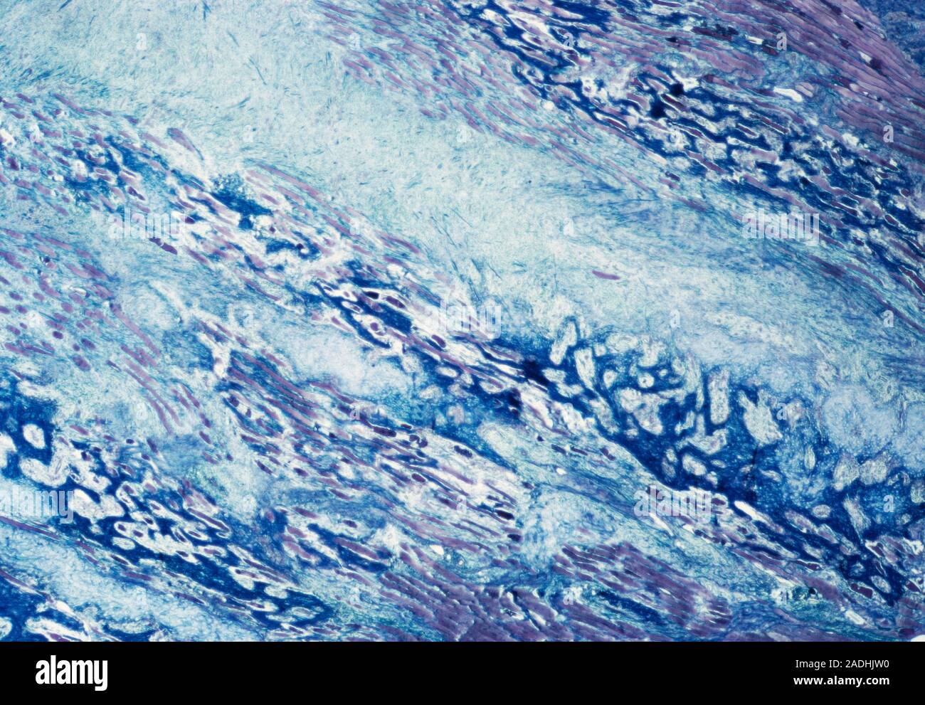 Abnormal bone growth. Light micrograph of a section through muscle ...