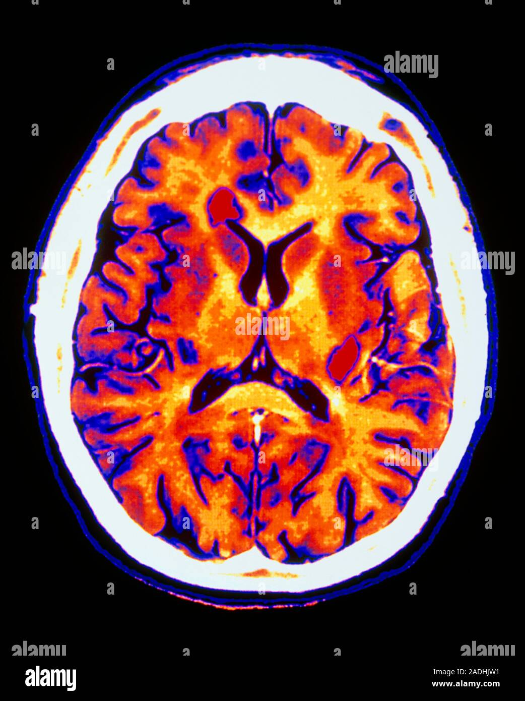 Multiple sclerosis. Coloured computed tomography (CT) scan of an axial section through the brain ...