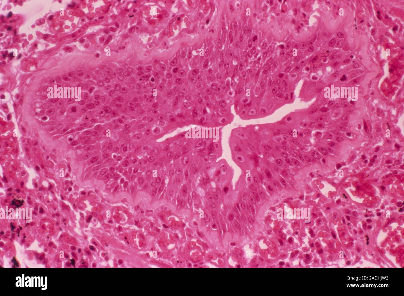 Lung metaplasia. Light micrograph of a section through bronchial ...